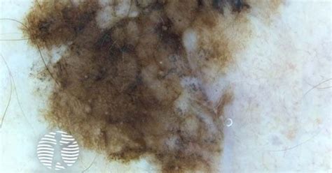 Dermnet® Dermoscopy Chaos Or Multicomponent Pattern Image