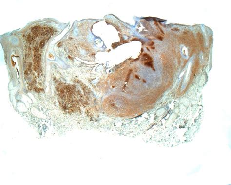 Atypical Fibroxanthoma Of The Cheek—case Report With Dermatoscopy And