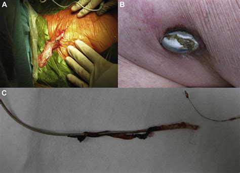 Leadless Pacemaker Implantation After Explantation Of Infected