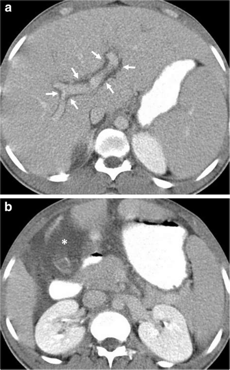 Dientamoeba Fragilis Wikiprojectmed