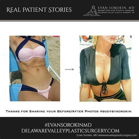 Real Patient Stories Before And After Gallery Patient 9