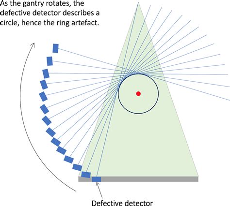 Ct Artefacts Radiology Cafe