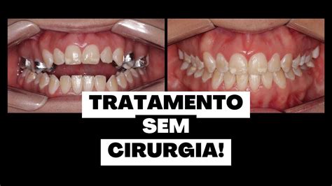 Tratamento Ortod Ntico Da Mordida Aberta Esquel Tica Sem Cirurgia Ortogn Tica Youtube