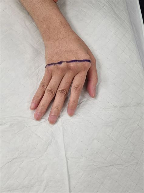 Esraa El Sawy On Linkedin Mcp Arthroplasty With Keriflex Prothesis For