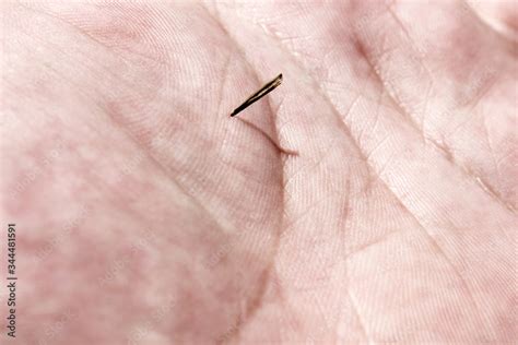 Splinter Palm Skin Hand Background For Medical Remove Spike Stock