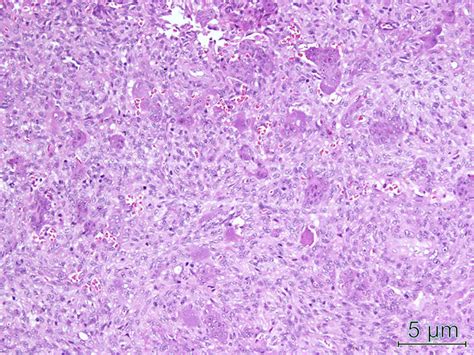 Pathologic Examination Showing Clusters Of Osteoclast Like Giant Cells