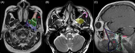 Anatomy Based Corridors To The Infratemporal Fossa Im