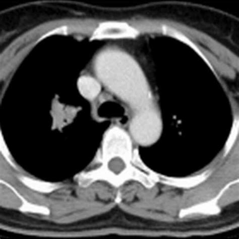 node type an irregular dense nodule was detected in the upper right