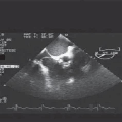 Pdf Diagnosis And Treatment Of Prosthetic Valve Dysfunction