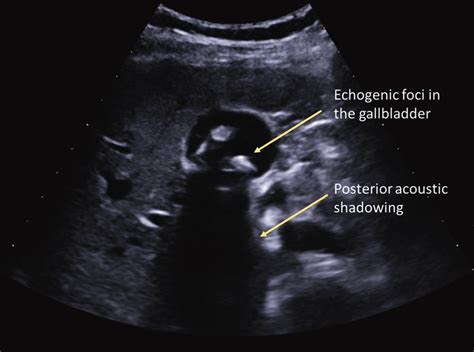 Shows The Presence Of Gallstones In The Gallbladder Echogenic Foci In Download Scientific