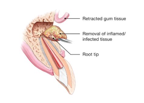 Endodontic Microsurgery In Pittsburgh Soft Touch Endodontics Apicoectomy