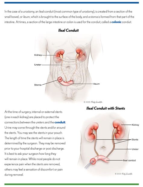 Is An Ileal Conduit A Urostomy At Indiana Seery Blog