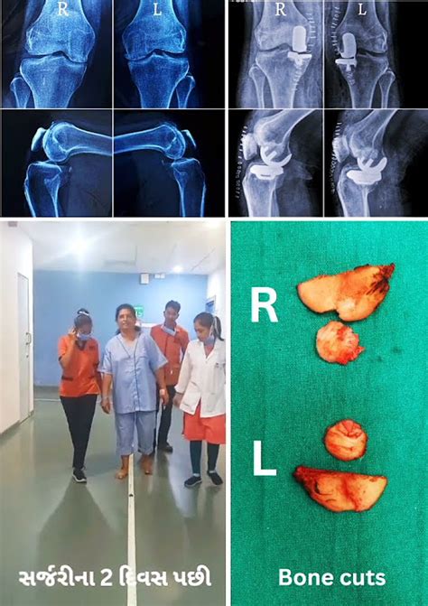 Watch It Bilateral Microplasty Vasundharaben Salvi