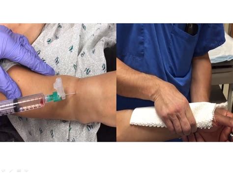 Closed Reduction Of Distal Radius Fractures —