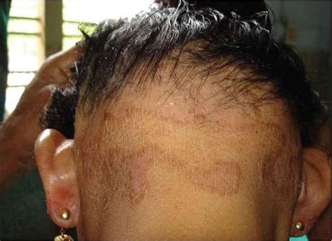 Zinc Deficiency Hair Loss