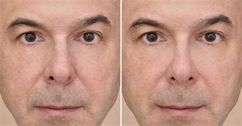 Preservation Rhinoplasty Natural Results Faster Recovery And Who It