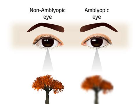 Amblyopia