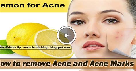 How To Remove Acne And Acne Marks Iconic Blogs