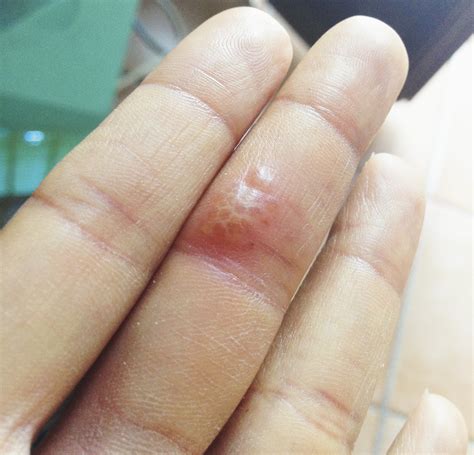 Herpetic Whitlow — Nejm