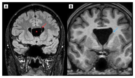 Symptomatic Cavum Septum Pellucidum And Vergae Cyst A Case Report