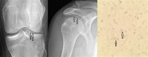 Chondrocalcinosis Vs Normal