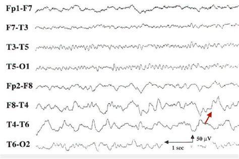 Repeat Image Of The Electroencephalogram Persistent Polymorphic Delta