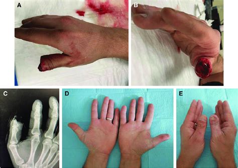 A 29 Year Old Male Patient With An Amputation Of The Distal P2 Of The