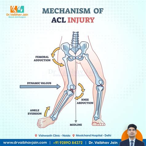 Understanding The Mechanism Of ACL Injury Orthopedic Doctor Vaibhav Jain Acl Surgery Surgery