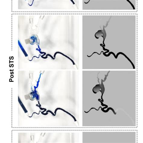 comparison between the dsa images and cfd results showing the contrast