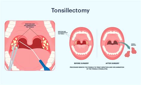 Tonsillectomy Cost In Hyderabad India Care Hospitals