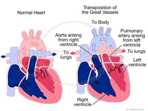 Transportation Of Great Arteries