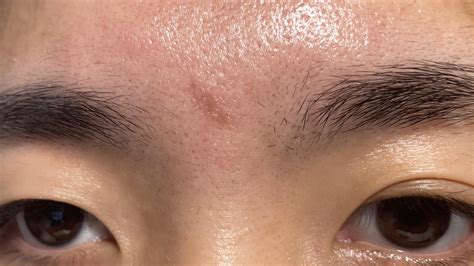 Hyperpigmentation Scar On Forehead Racnescars