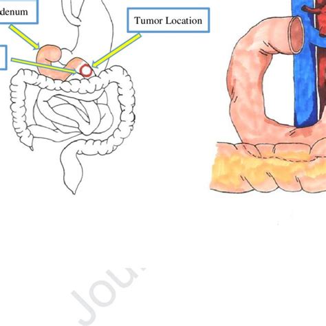 Gist Tumor Black Arrow Located On The Anterior Aspect Of Gastric Download Scientific Diagram
