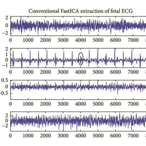 improved fastica algorithm for extraction of fetal ecg s1 and golden