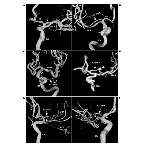 Figure Mca Anomalies On Angiography A Three Dimensional Dsa Of The