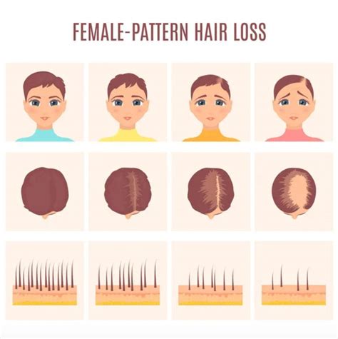 Female Pattern Baldness Hair Loss In Women Harley Street Htc