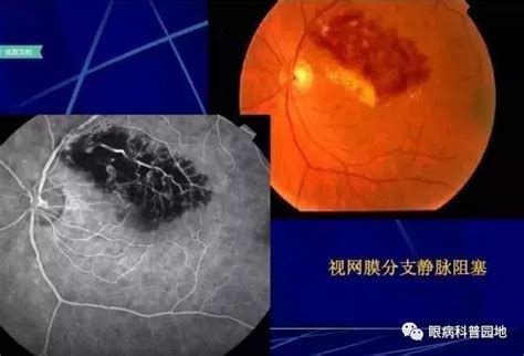 眼睛造影是什么意思 眼睛造影 正常人的眼底造影图 大山谷图库