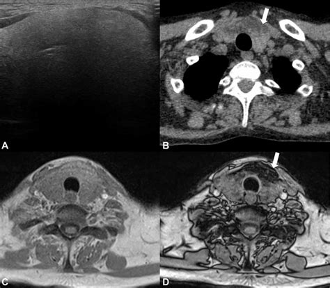 A Sonography Reveals A Diffusely Enlarged Thyroid With Marked Acoustic