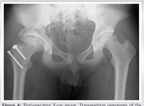 Pdf Subchondral Fatigue Fracture Of The Femoral Head With Acetabular Dysplasia Treated By