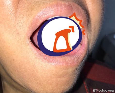 愛抽菸、喝酒小心！醫揭「口腔癌分期」超驚人 一張圖秒懂腫瘤往哪跑 Ettoday健康雲 Ettoday新聞雲