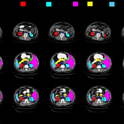 comparison of segmentation results of different models on the synapse