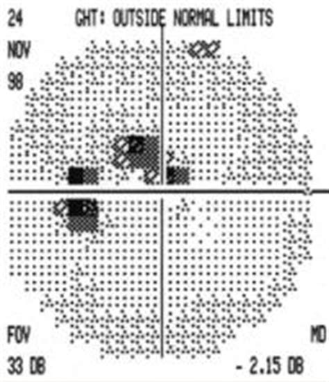 Visual Field Testing Visual Surgery