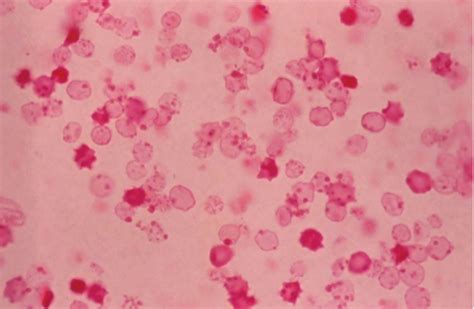 Ghost Cell Glaucoma Eyewiki