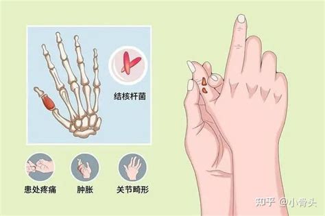 骨结核会遗传吗？ 知乎