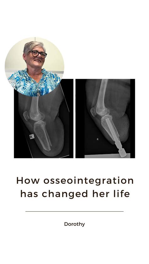 Pams Osseointegration Story Empowerment Pam Reflects On The Everyday Comfort And Freedom She