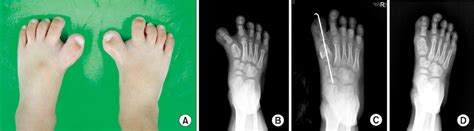 Congenital Hallux Varus Atavistic Great Toe Pediatrics Orthobullets