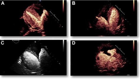 Contrast Enhanced Transthoracic Echocardiography Download Scientific Diagram