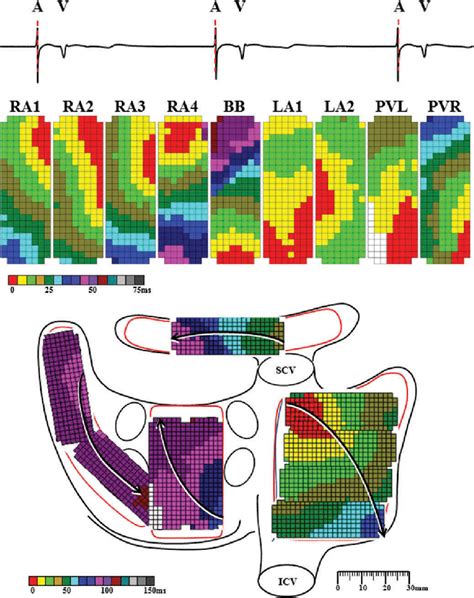 Epicardial High Resolution Mapping Of Sinus Rhythm Upper Panel Download Scientific Diagram