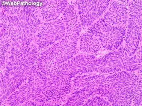 Inverted Urothelial Papilloma