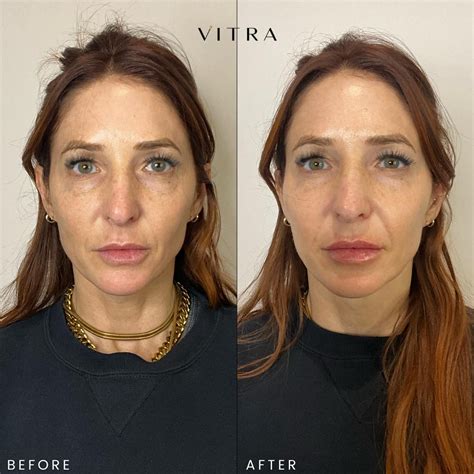 The Equation For Perfection Vitra Aesthetics Clinic